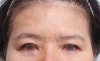 내시경 이마 눈썹 거상술 미간 주름 콧잔등 주름 없애기 네이버 블로그